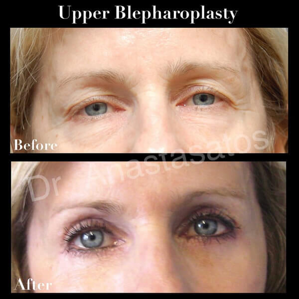 Πλαστικη Χειρουργικη Αθηνα Ελλαδα | λιφτινγκ, ανορθωση στηθους ...
